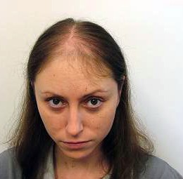 Female Hair Loss | Hair Thinning Treatments - Hair Solved